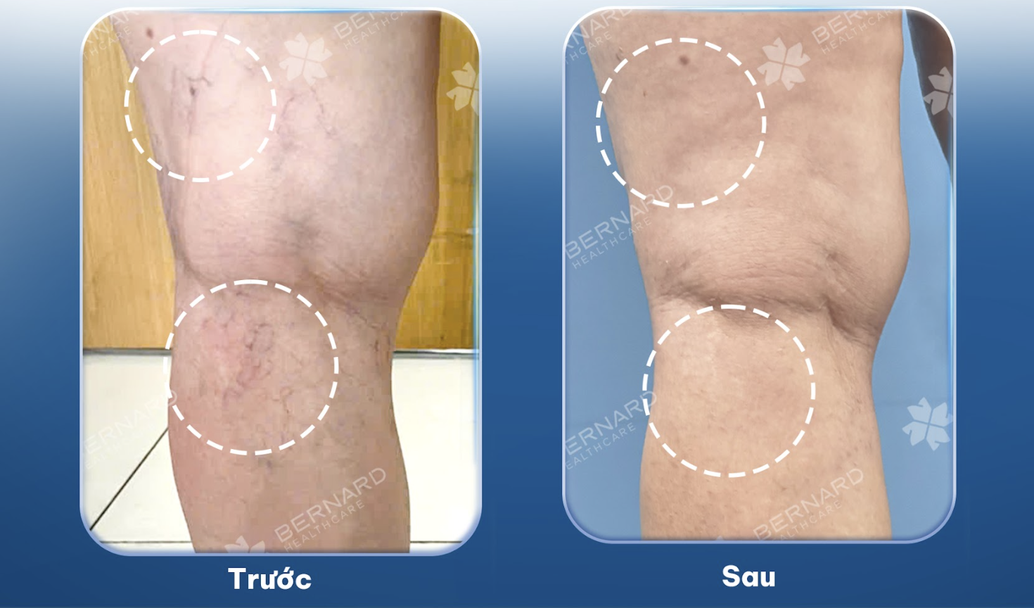 2 lần tiêm xơ thất bại ở Mỹ, gân xanh biến mất nhờ công nghệ mới tại Bernard